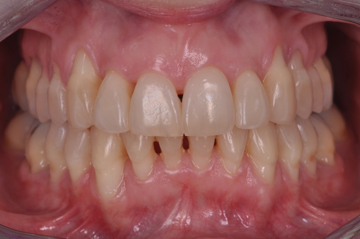 Periodontitis avanzada: Tratamiento del mes - Zabalegui