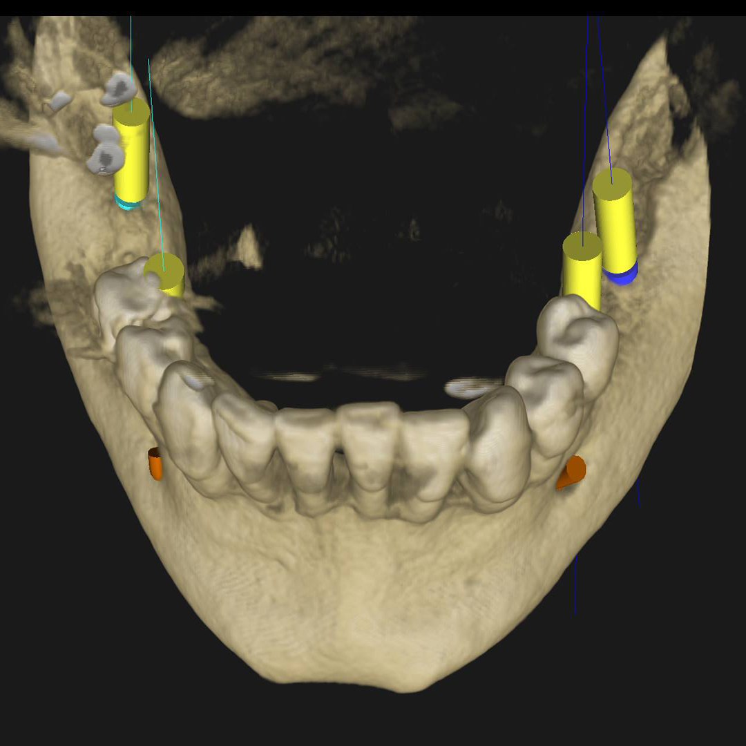 Qué son los CBCT | Implantes dentales y Periodoncia | Clínica Dental